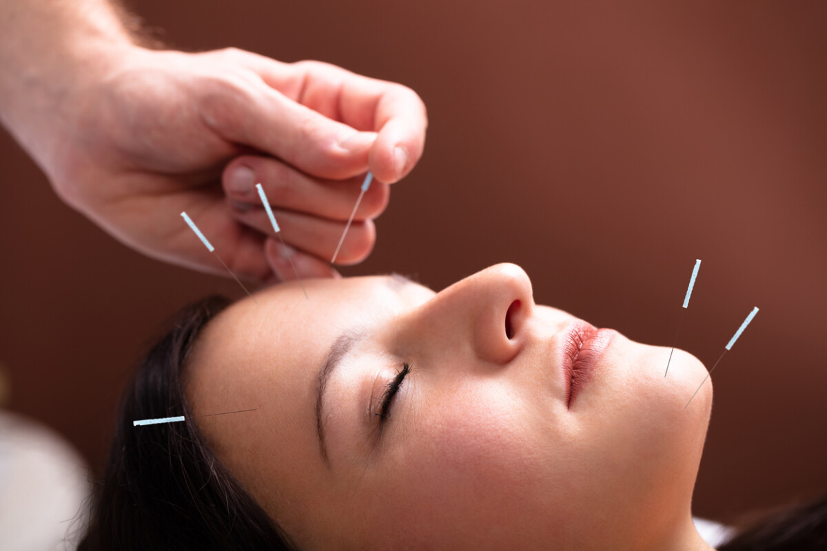 Top 10 Benefits of Acupuncture - Thumos Health Center