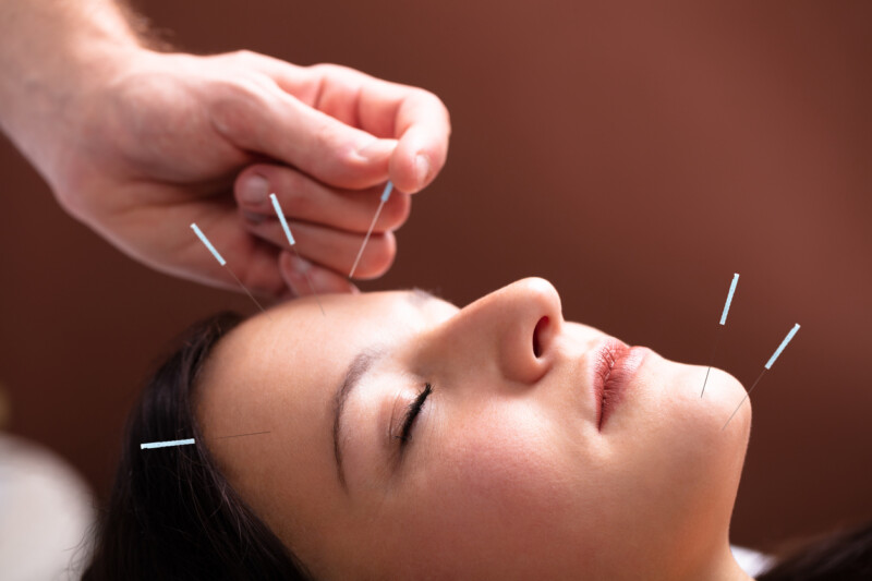 Top 10 Benefits of Acupuncture - Thumos Health Center